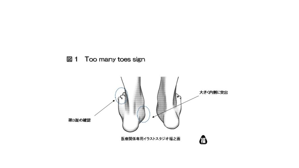 扁平回内足への対応 PADでのコントロール